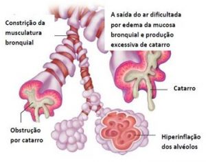 DPOC - a doença pulmonar obstrutiva crônica - Dr. Michael W. Groh